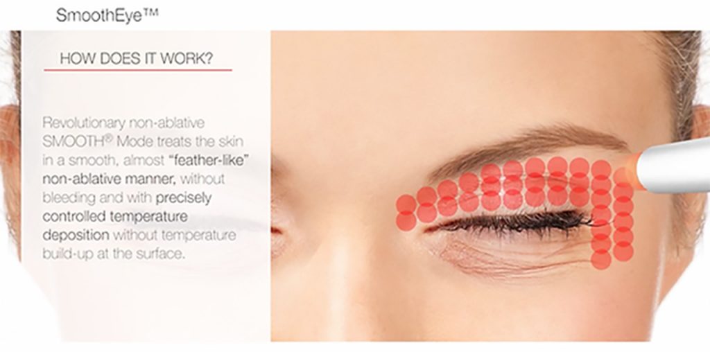 Fotona SmoothEye | Genesis Cosmetic Laser Center